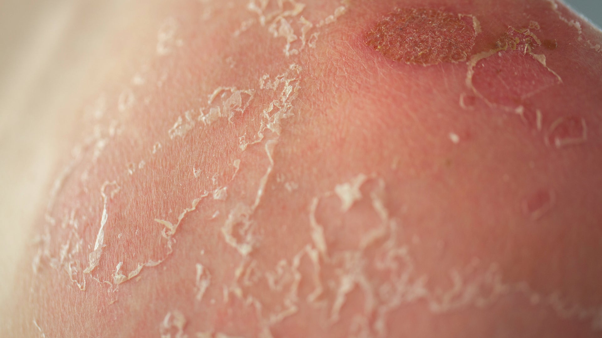 How to Treat and Prevent Sunburn | Seacra Skincare