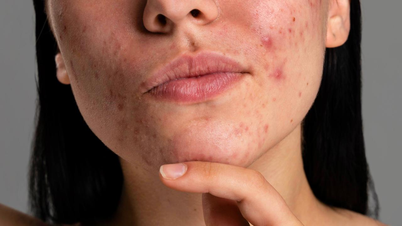 Why Acne Flares Up and How to Calm It: The Natural Way with Seacra ...