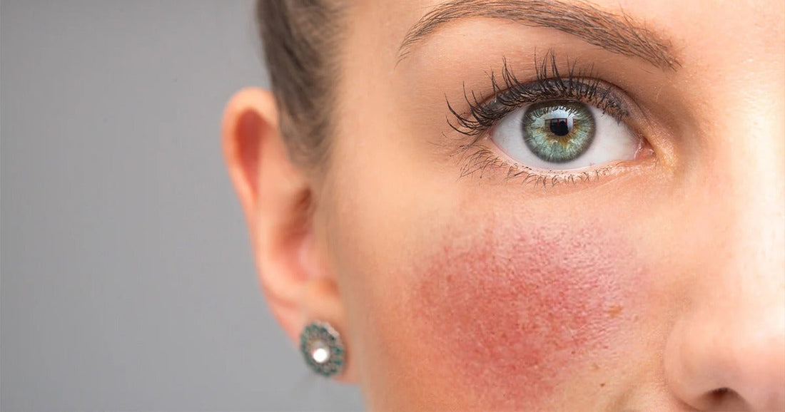 How to Reduce Redness on Face Quickly – Backed by Science – Seacra Skincare